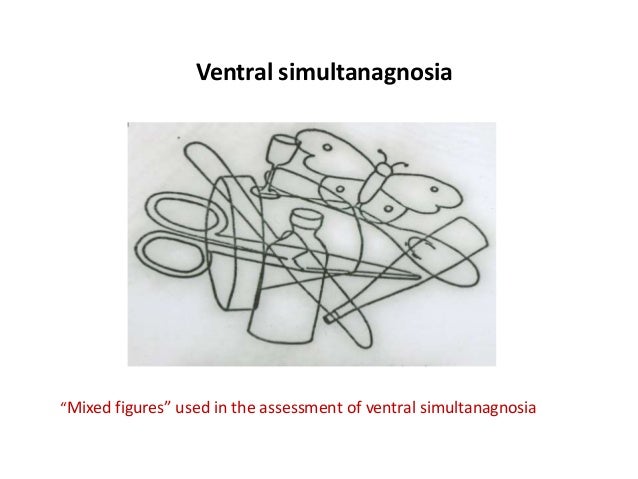 Occipital lobe 2 syndromes nwnw ppt