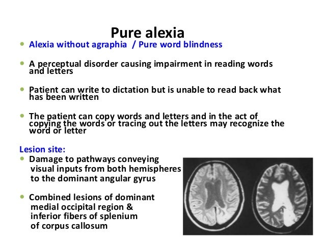 Occipital lobe 2 syndromes nwnw ppt