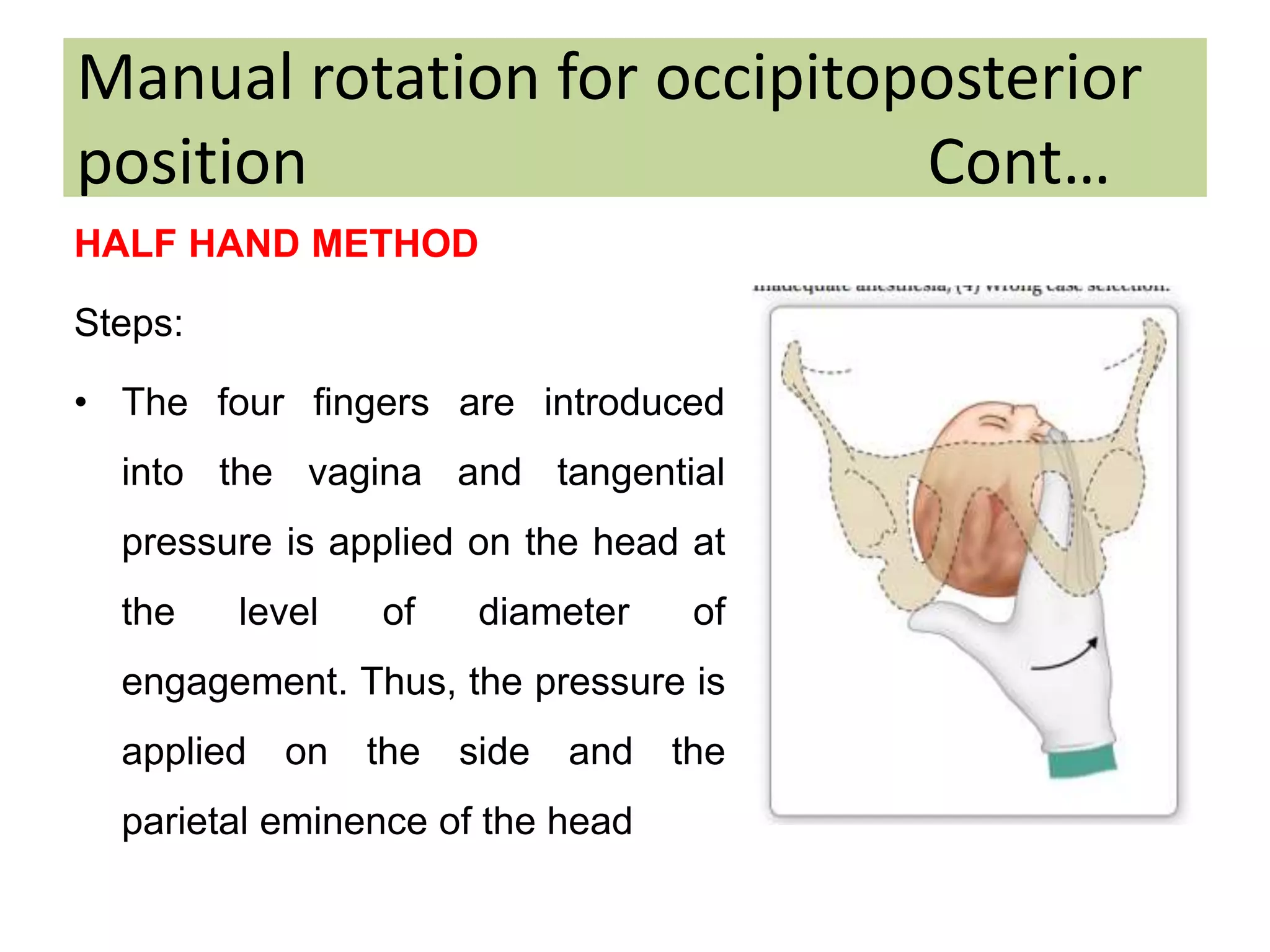Occipito posterior position | PPTX