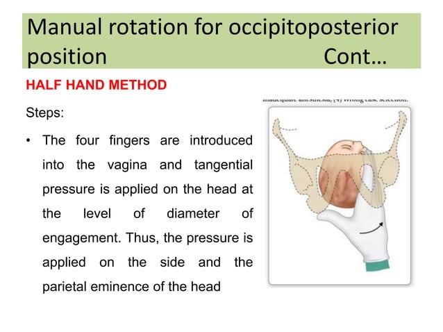 Occipito posterior position | PPTX | Pregnancy | Reproductive Health