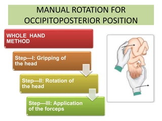 Occipito posterior position | PPT