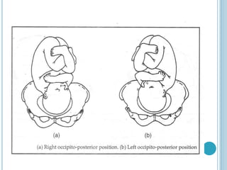 Occipito posterior position | PPT