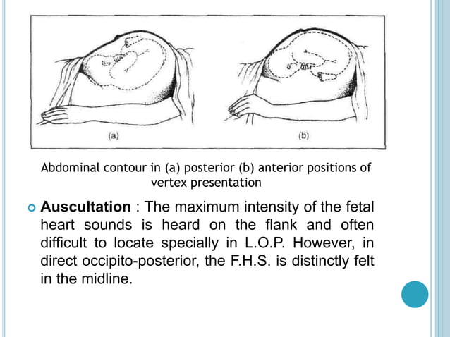 Occipito posterior position