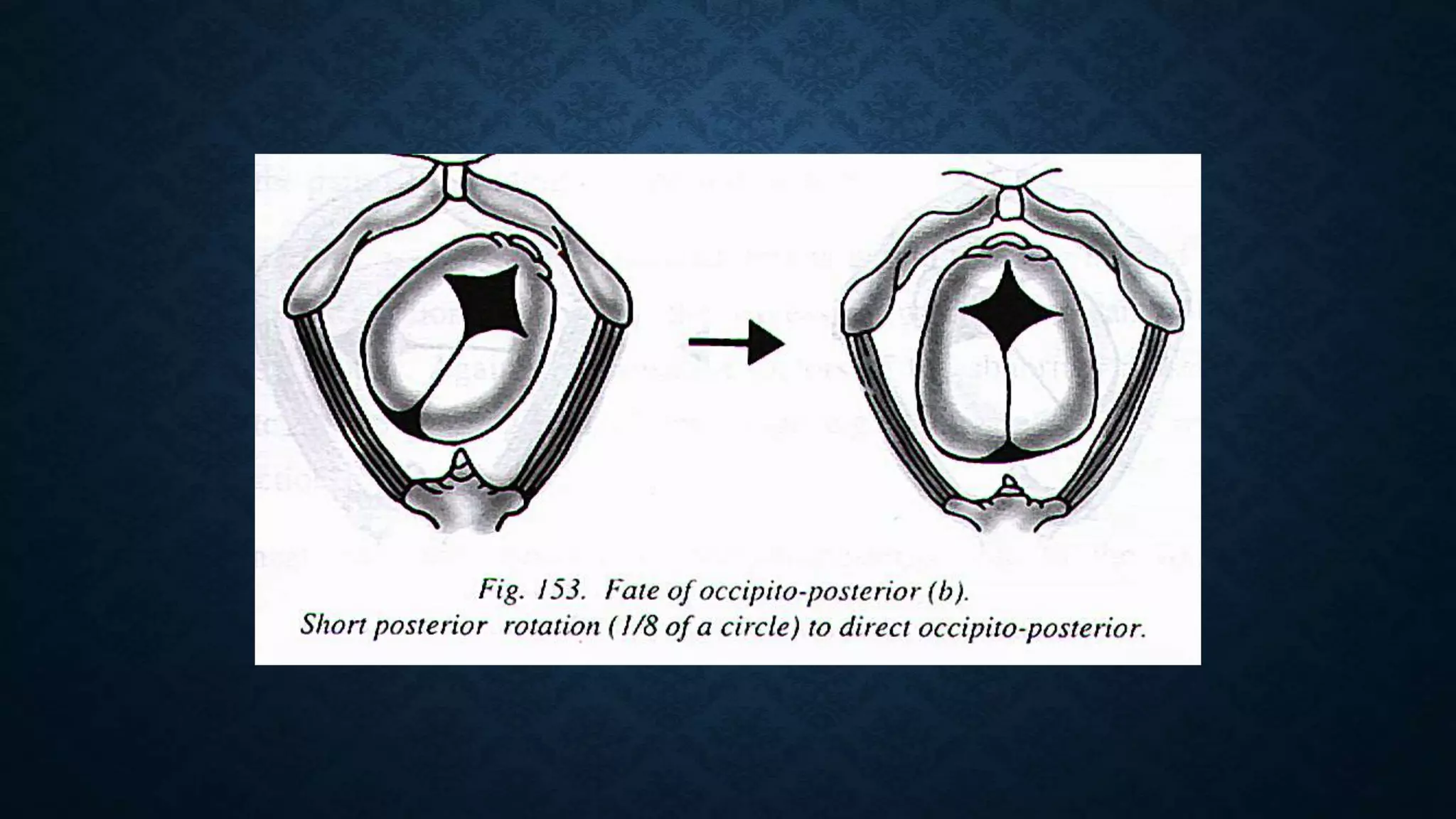 occipito posterior and shoulder presentation.pptx