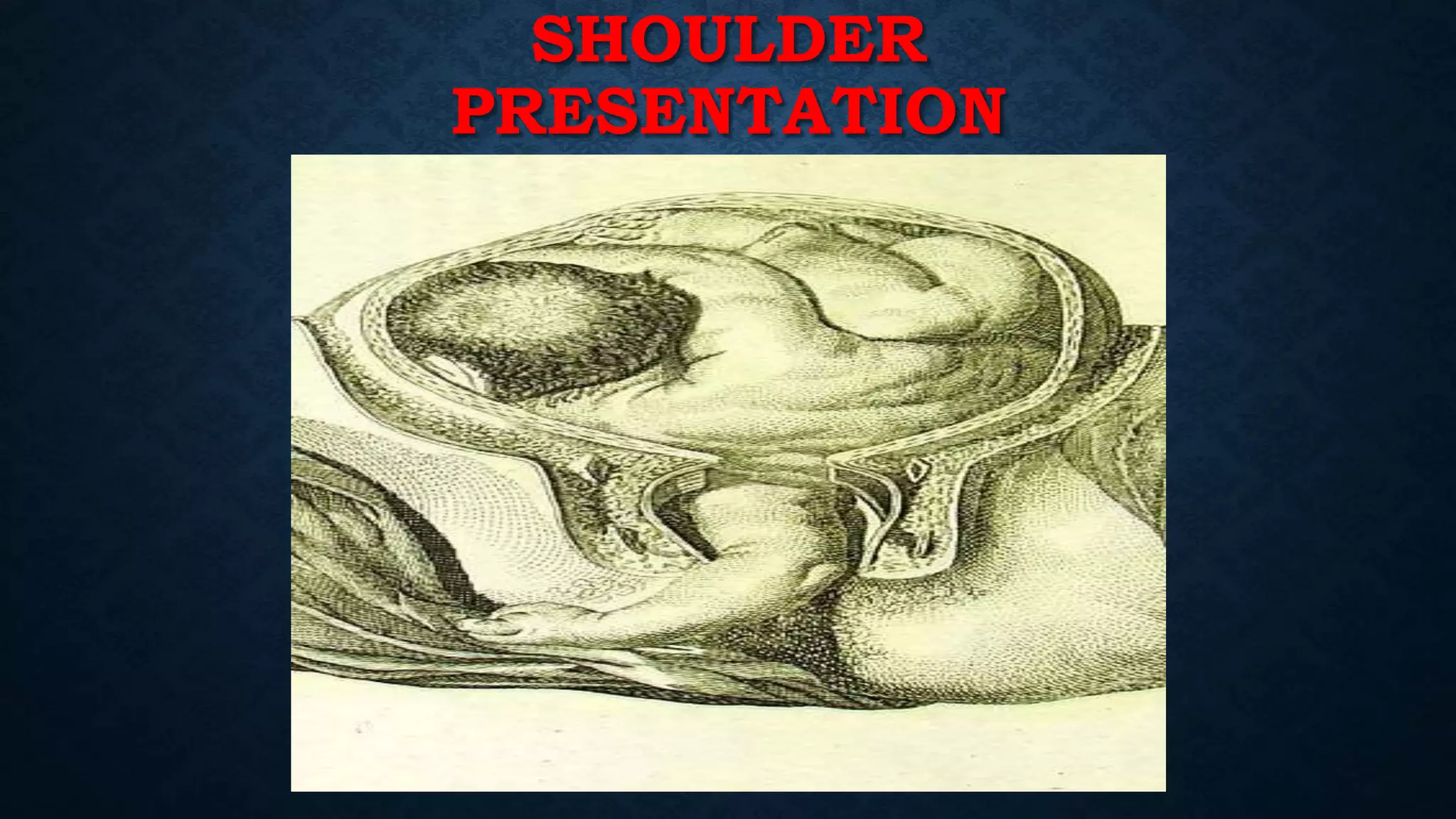 occipito posterior and shoulder presentation.pptx