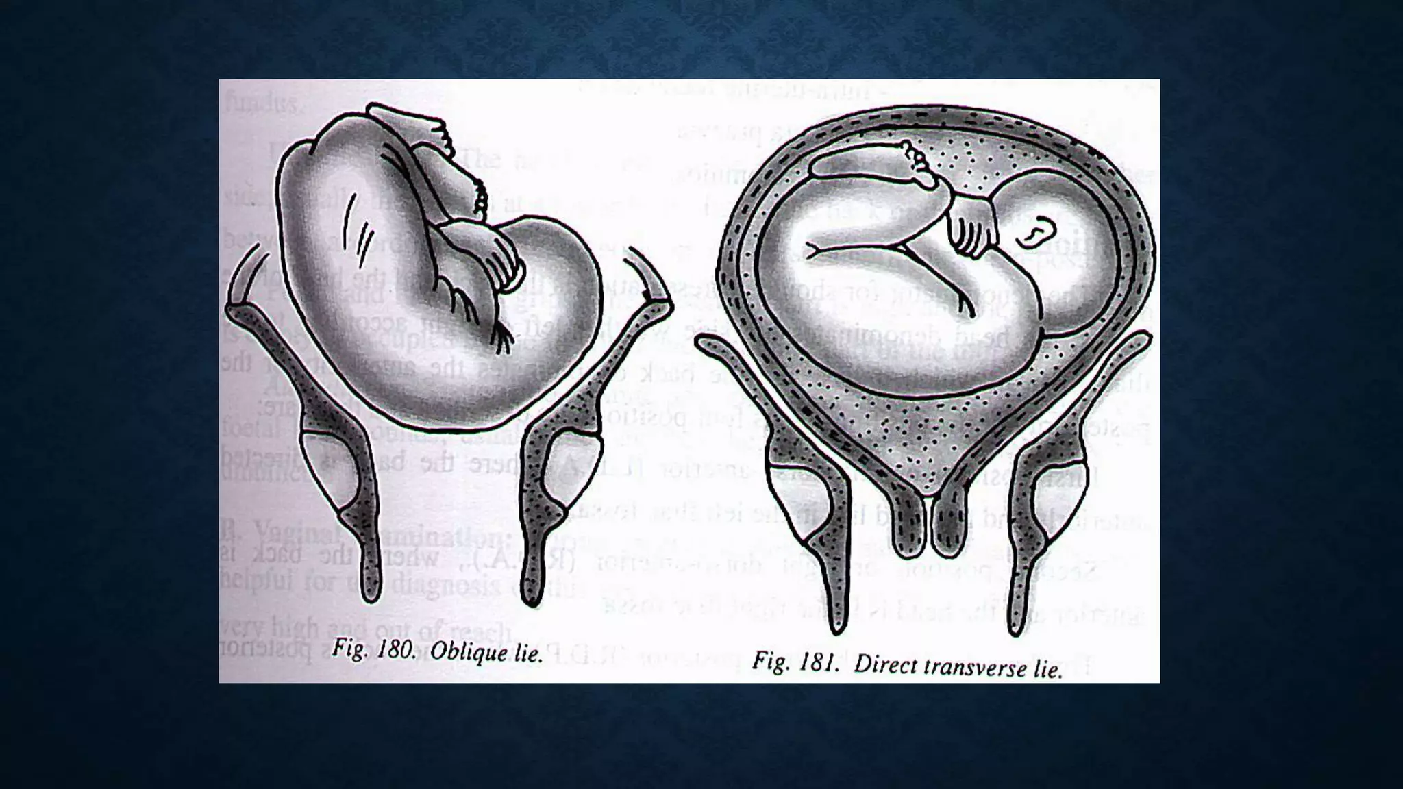 occipito posterior and shoulder presentation.pptx