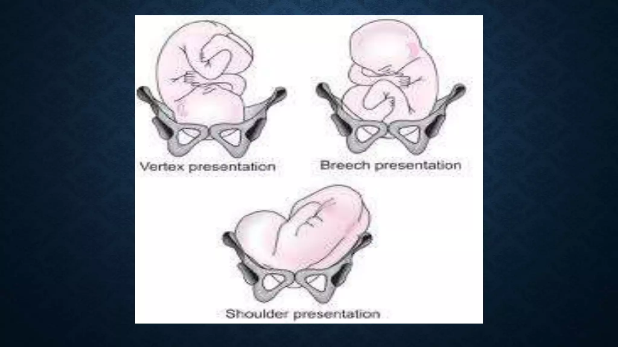 occipito posterior and shoulder presentation.pptx