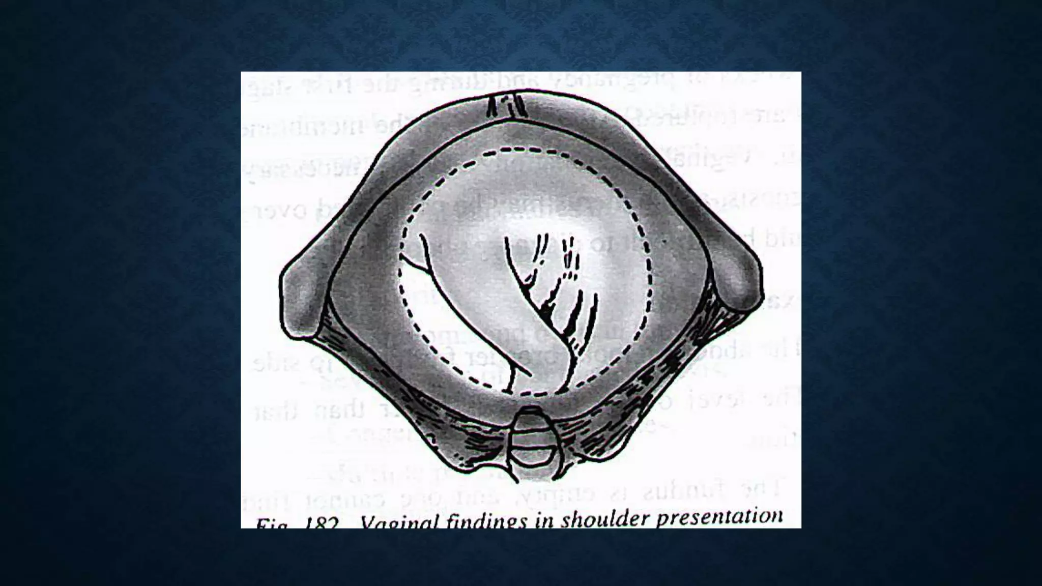 occipito posterior and shoulder presentation.pptx