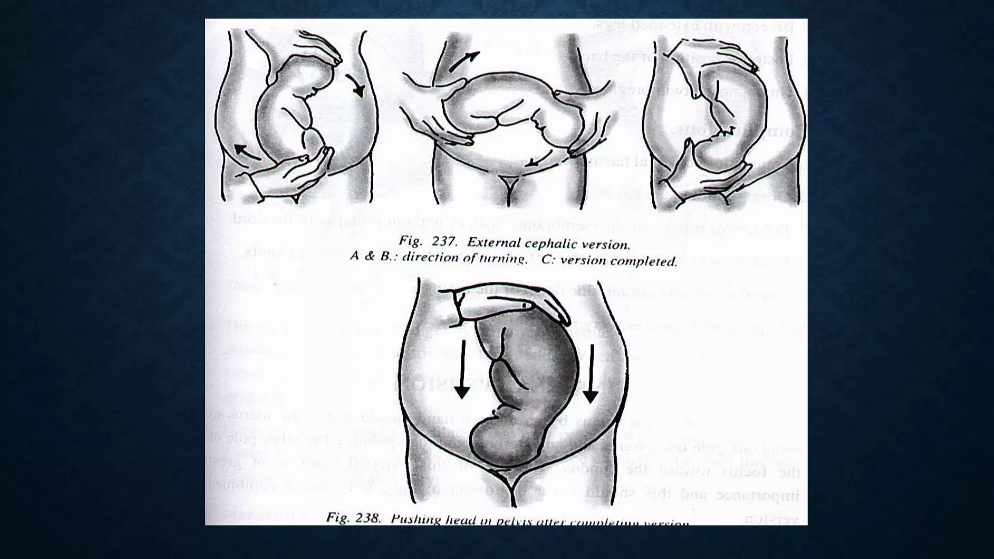 occipito posterior and shoulder presentation.pptx