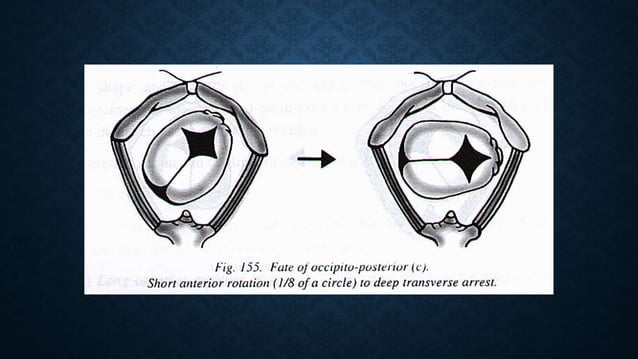 occipito posterior and shoulder presentation.pptx