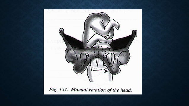 occipito posterior and shoulder presentation.pptx