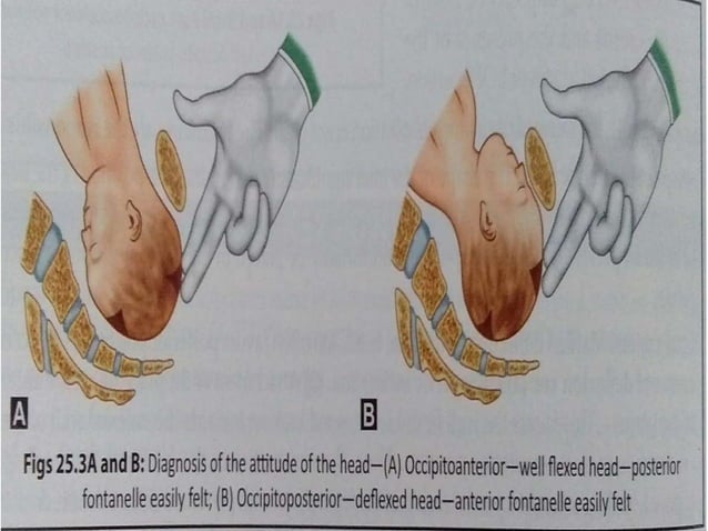 Occipito posterior position | PPTX