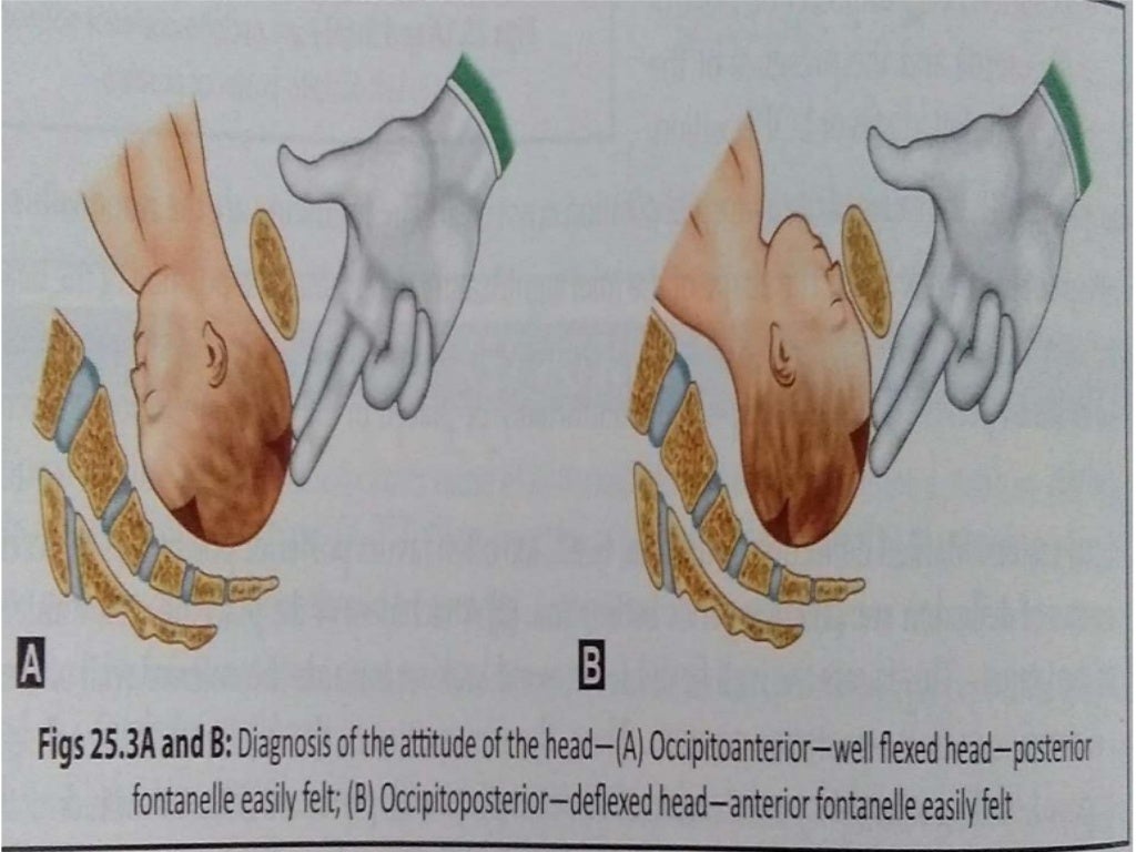 Occipito posterior position