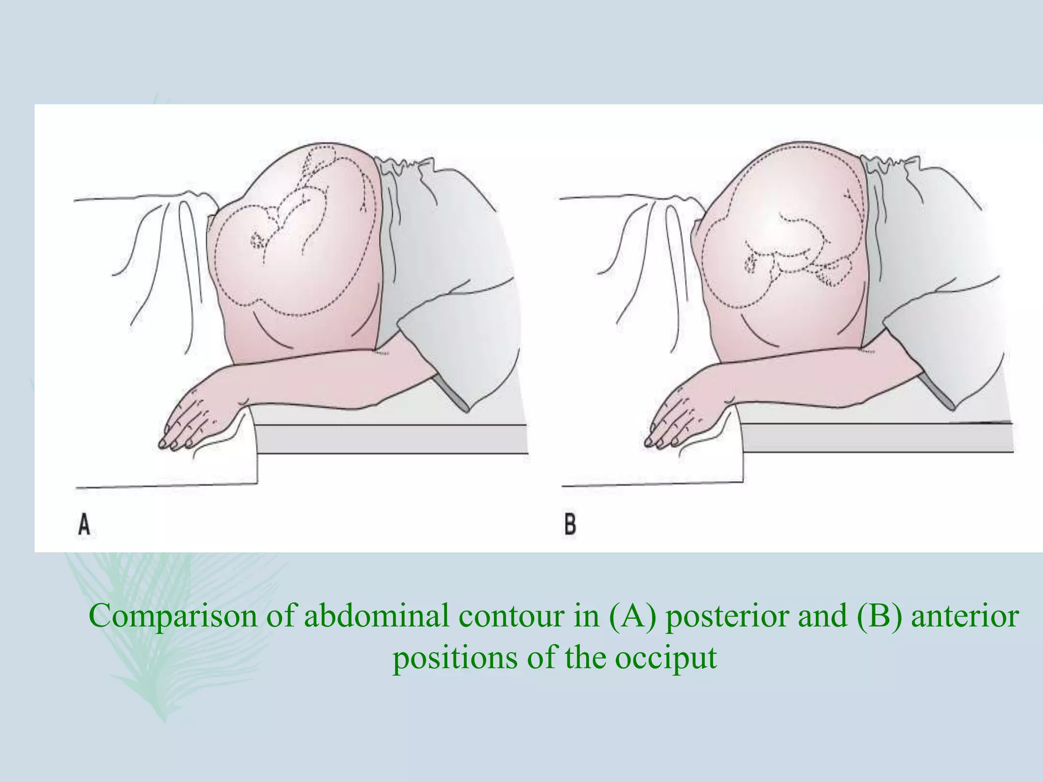 Occipito posterior position | PPTX