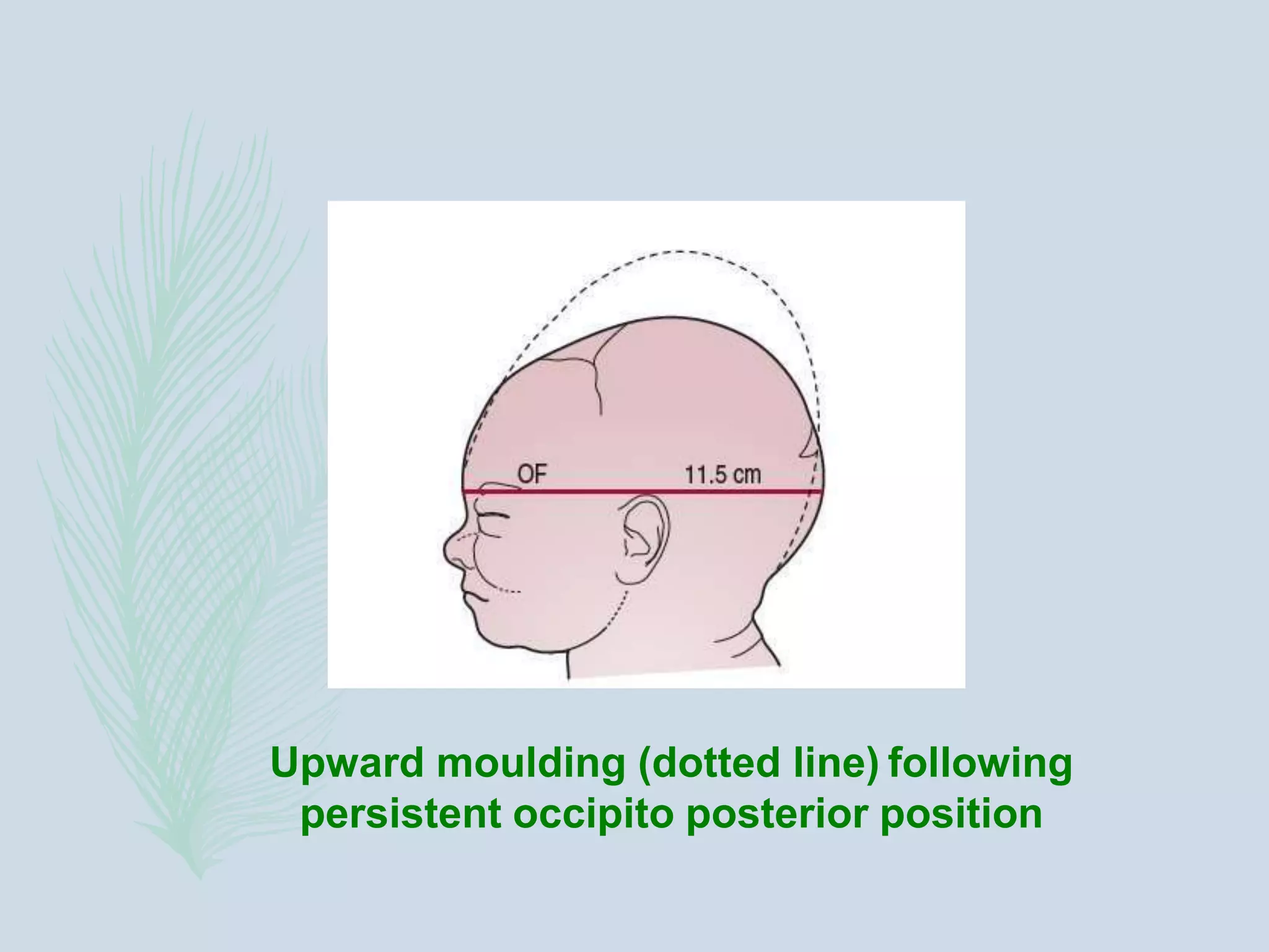 Occipito posterior position | PPTX