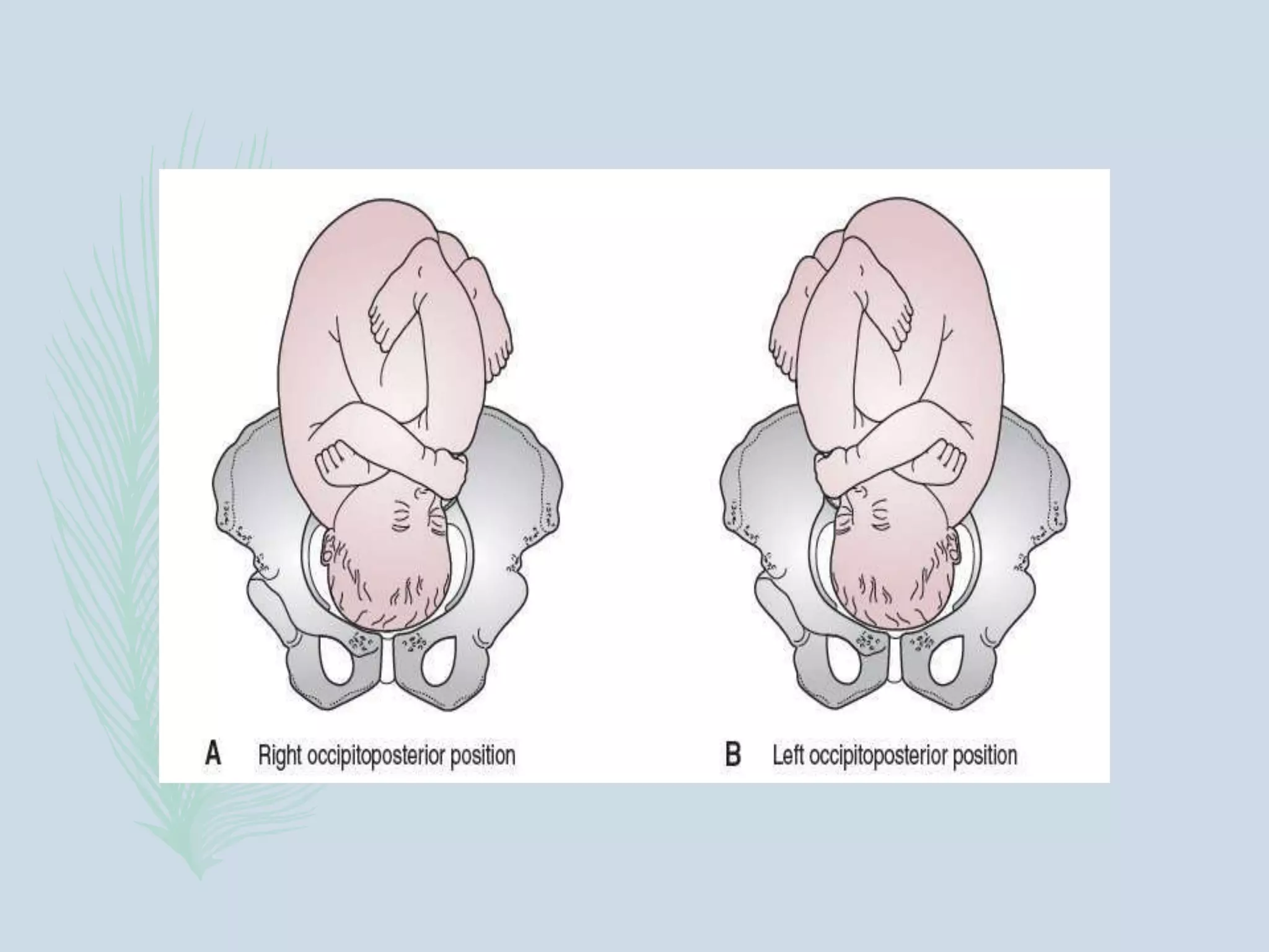 Occipito posterior position | PPTX