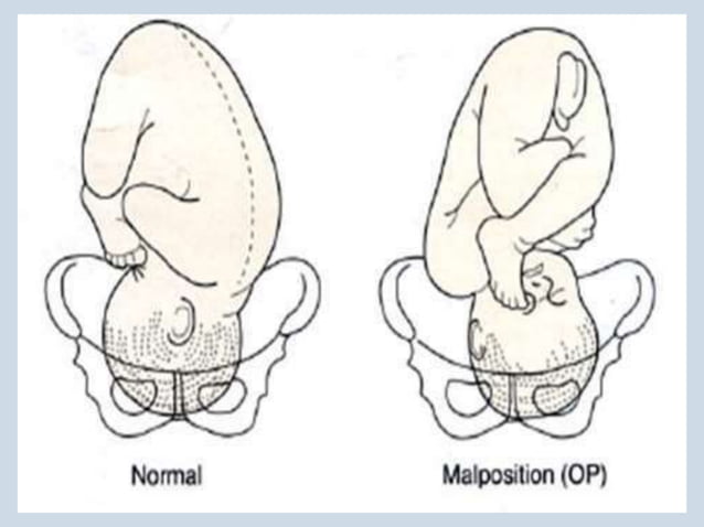 Occipito posterior position