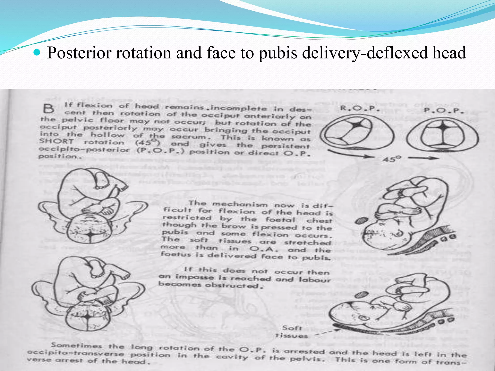 Occipitoposterior position | PPTX