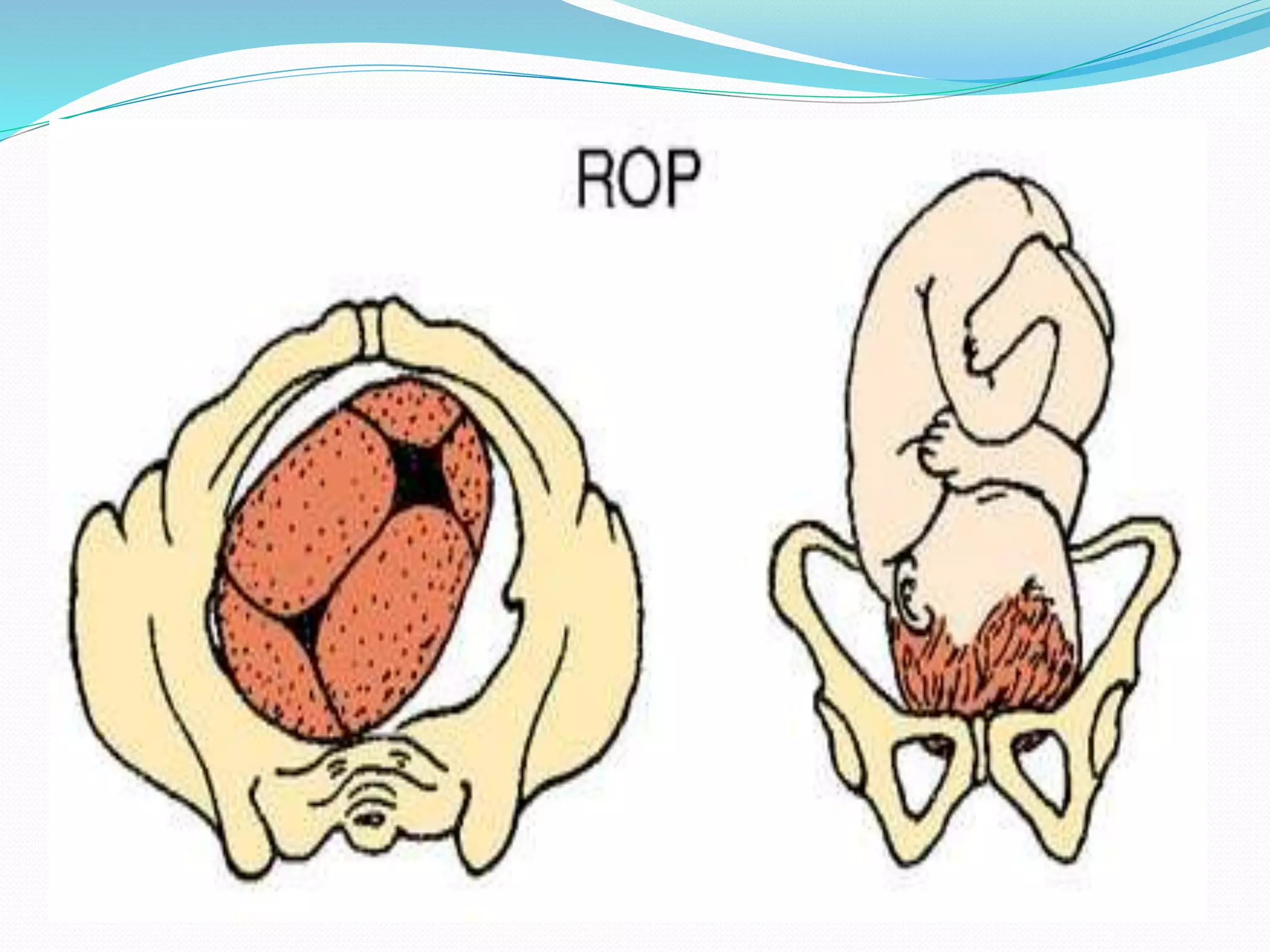 Occipitoposterior position | PPTX