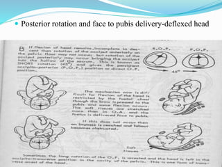 Occipitoposterior position | PPTX