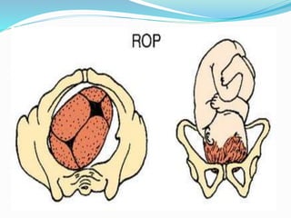 Occipitoposterior position | PPTX