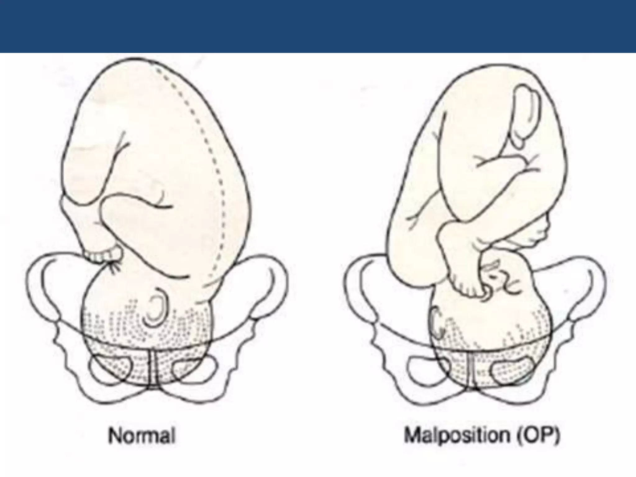 Occipito posterior position | PPT