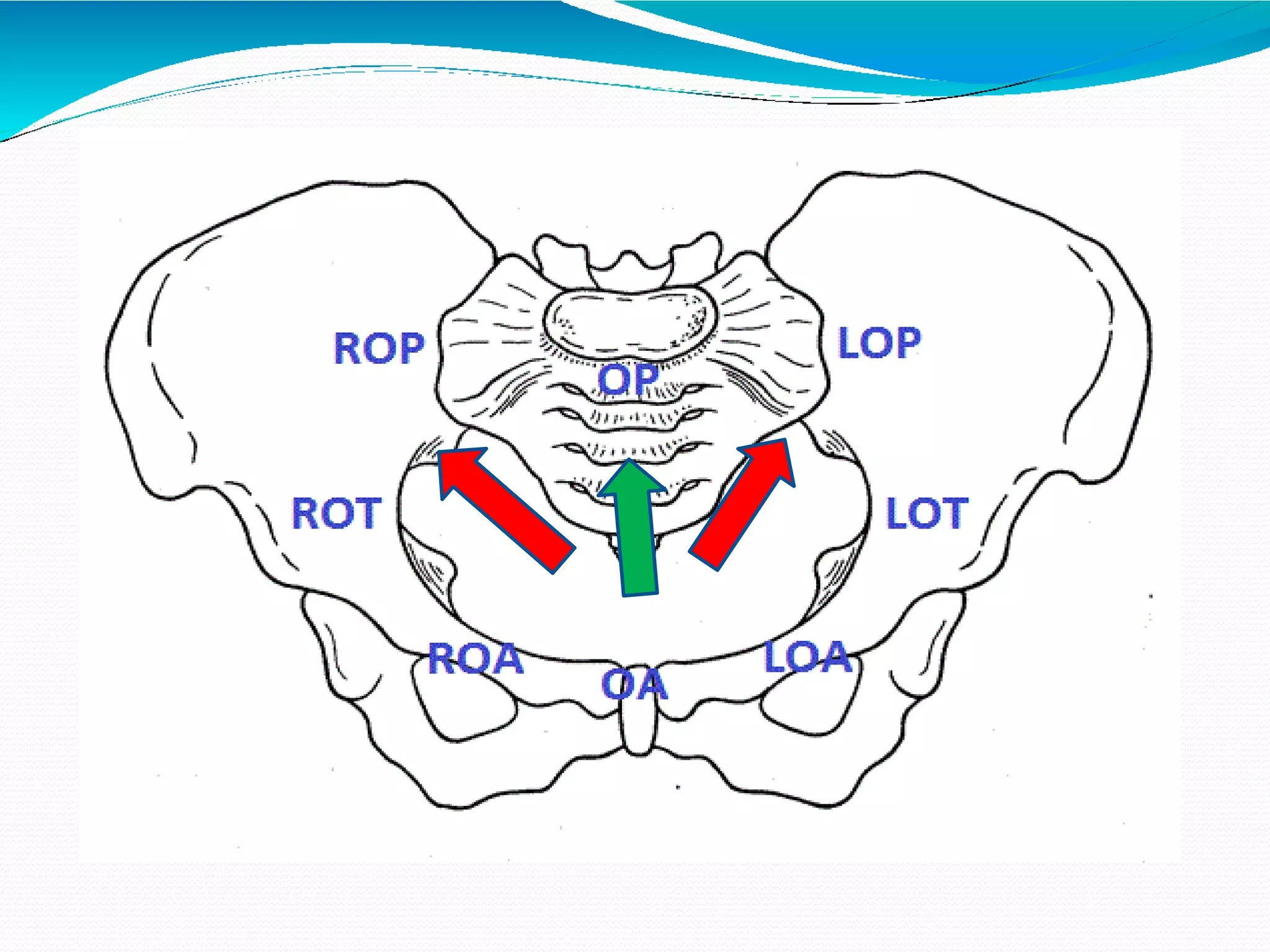 occipitoposteriorpositition-160811105500.pptx