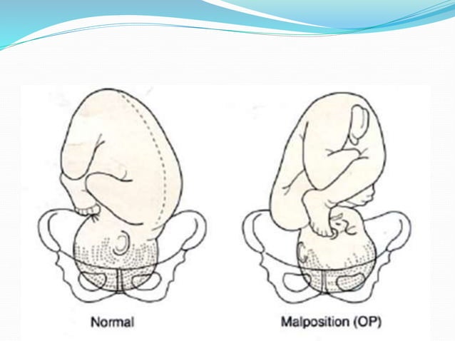 Occipito posterior positition