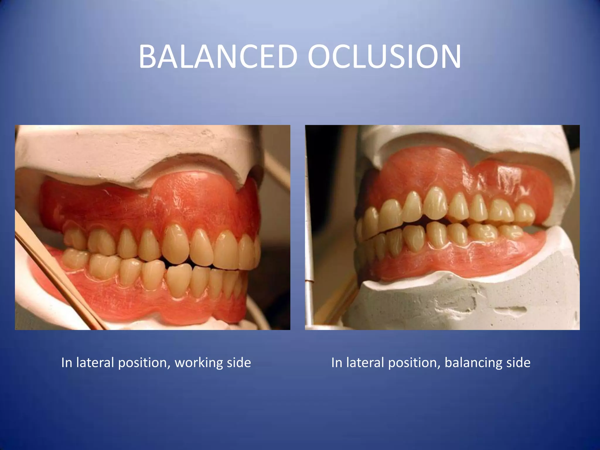 Occluion in prosthodontics | PPTX