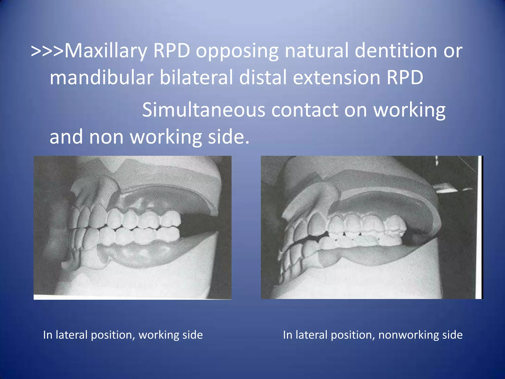 Occluion in prosthodontics | PPTX