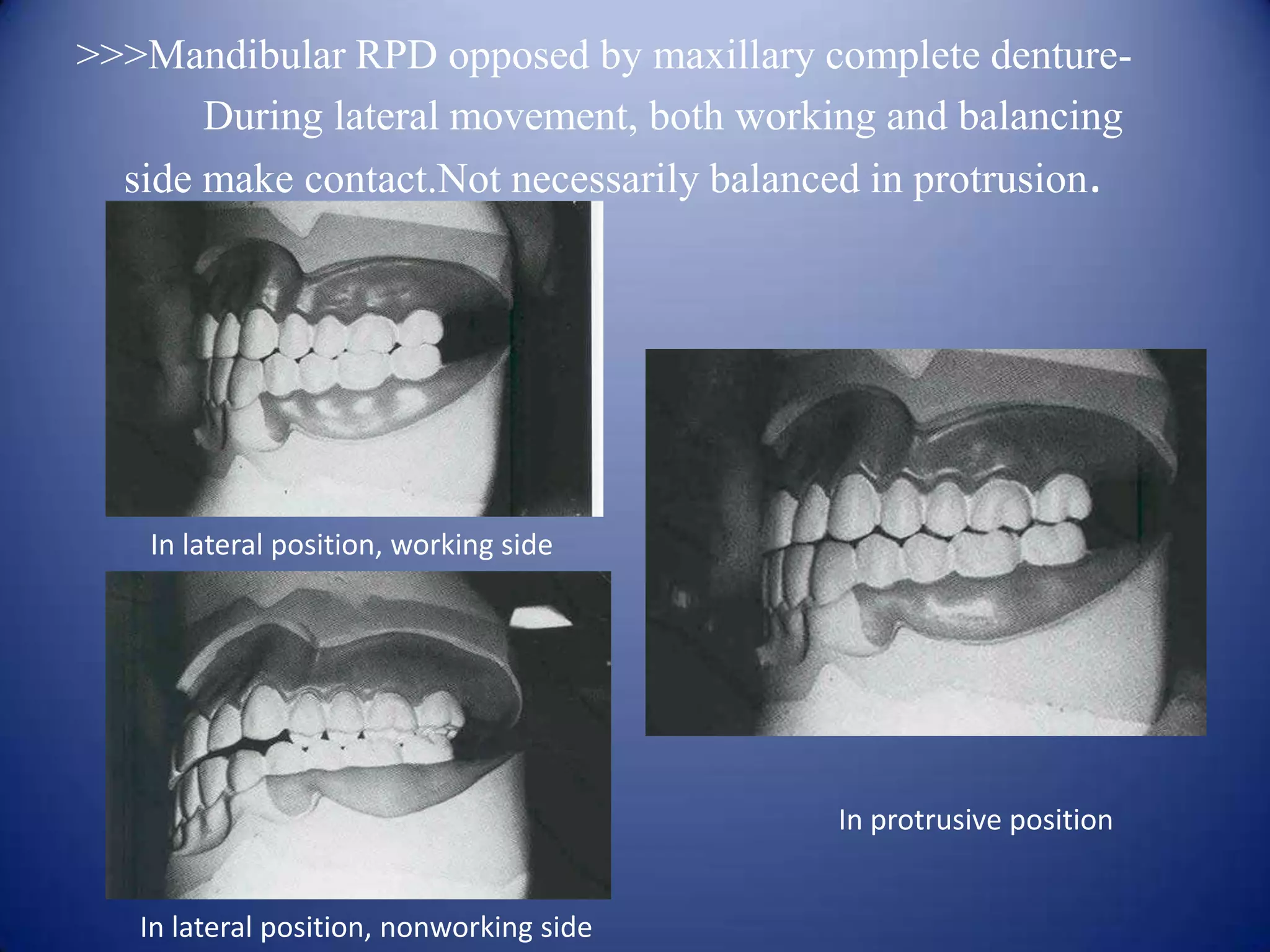 Occluion in prosthodontics | PPTX
