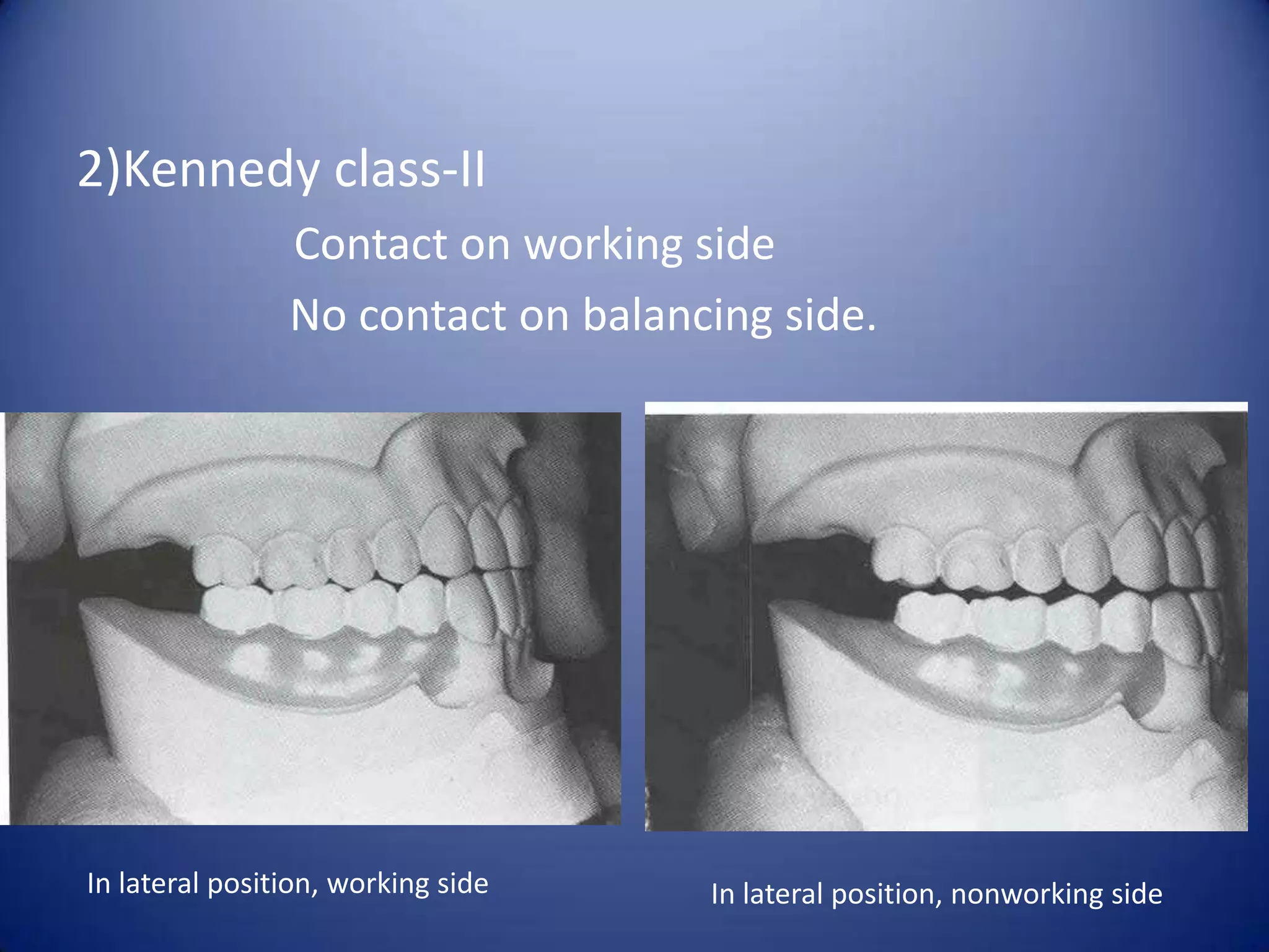 Occluion in prosthodontics | PPTX