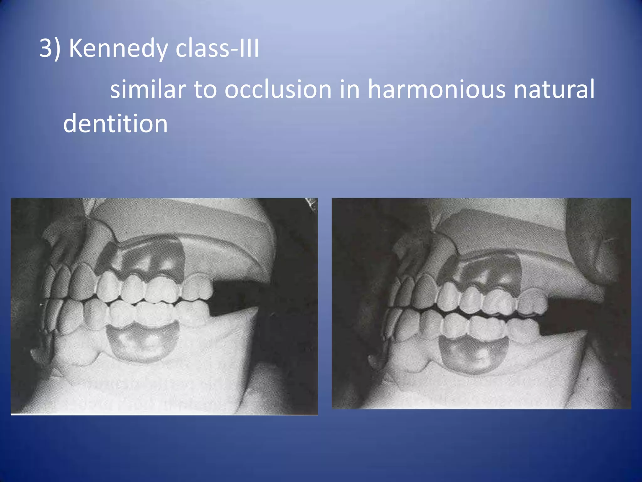 Occluion in prosthodontics | PPTX