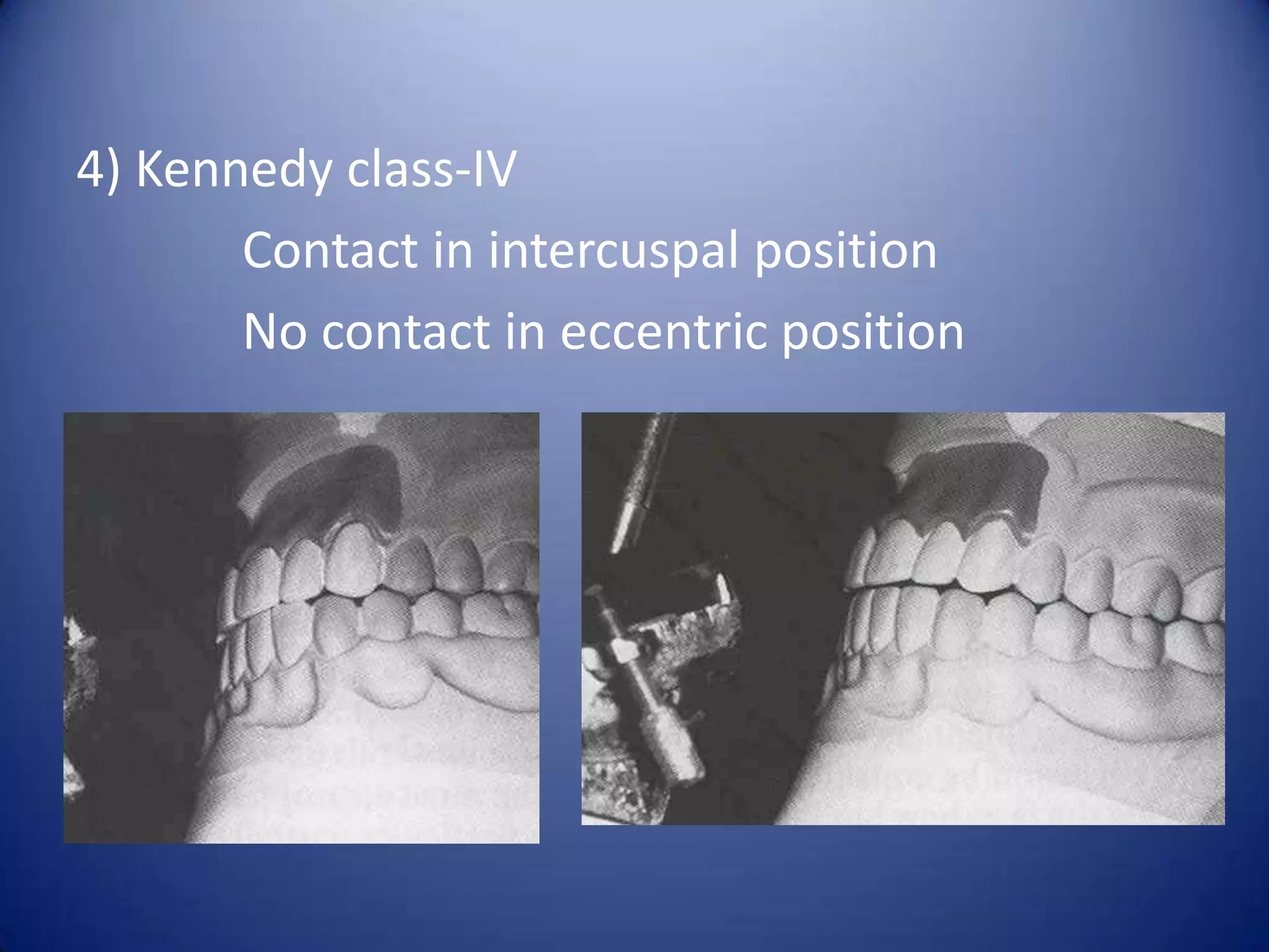 Occluion in prosthodontics | PPTX