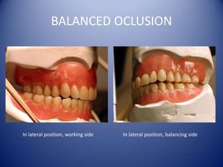 Occluion in prosthodontics | PPTX