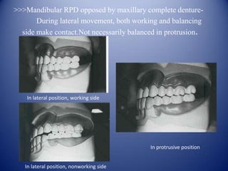 Occluion in prosthodontics | PPTX