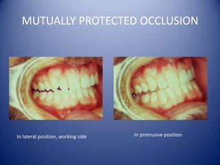 Occluion in prosthodontics | PPTX