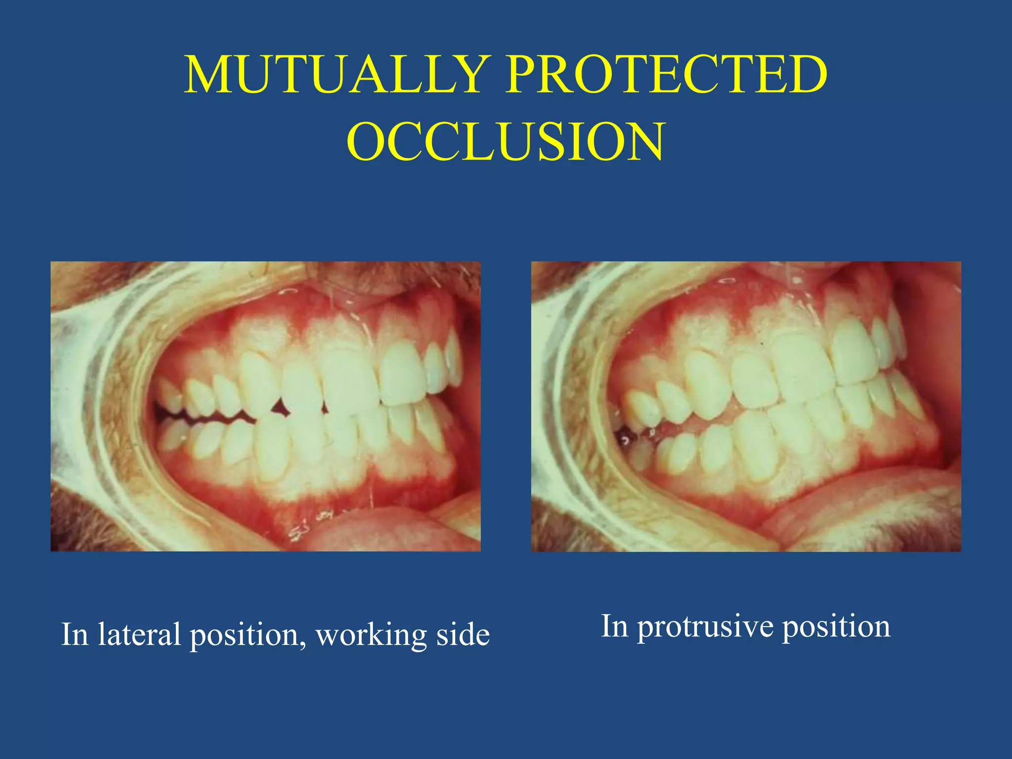 Occluion in prosthodontics lec 16 04-'13 | PPTX