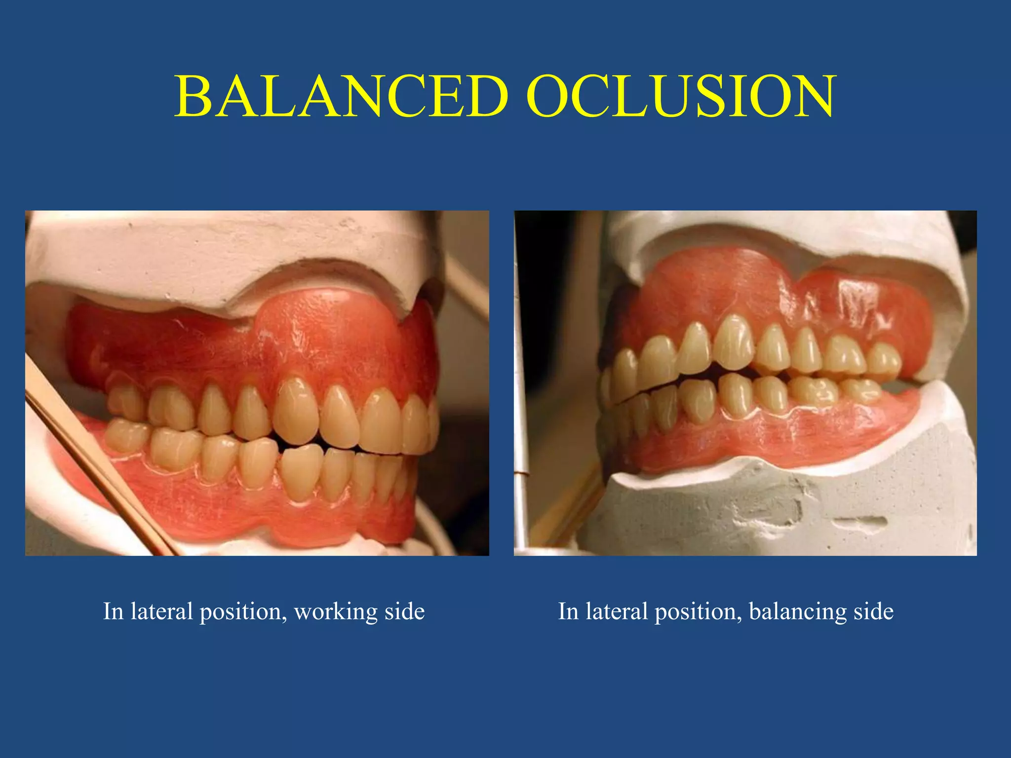 Occluion in prosthodontics lec 16 04-'13 | PPTX | Dental Health ...