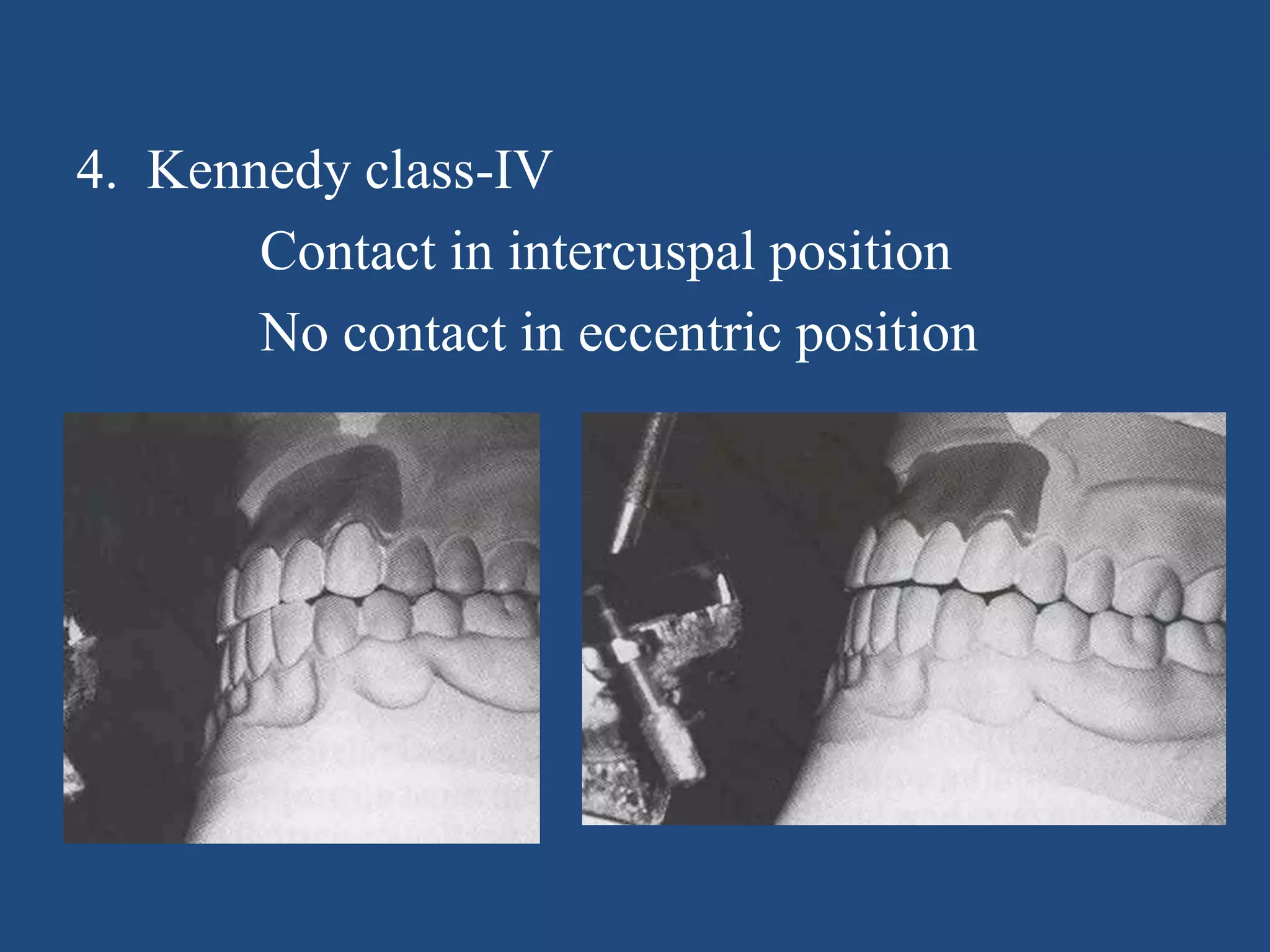 Occluion in prosthodontics lec 16 04-'13 | PPTX