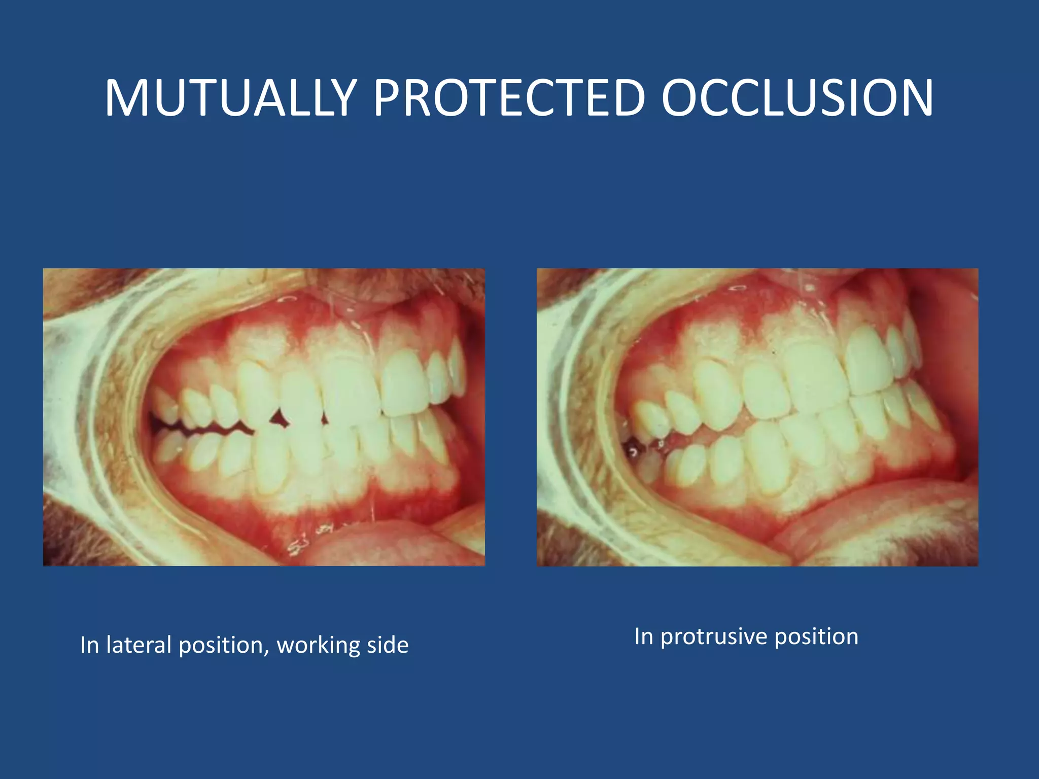 Occluion in prosthodontics lec 16 04-'13 | PPTX