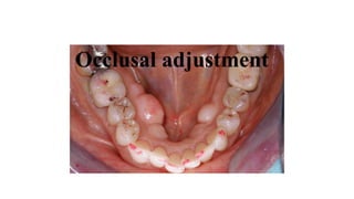 occlusal adjustment dental 10th sem dental students | PPTX
