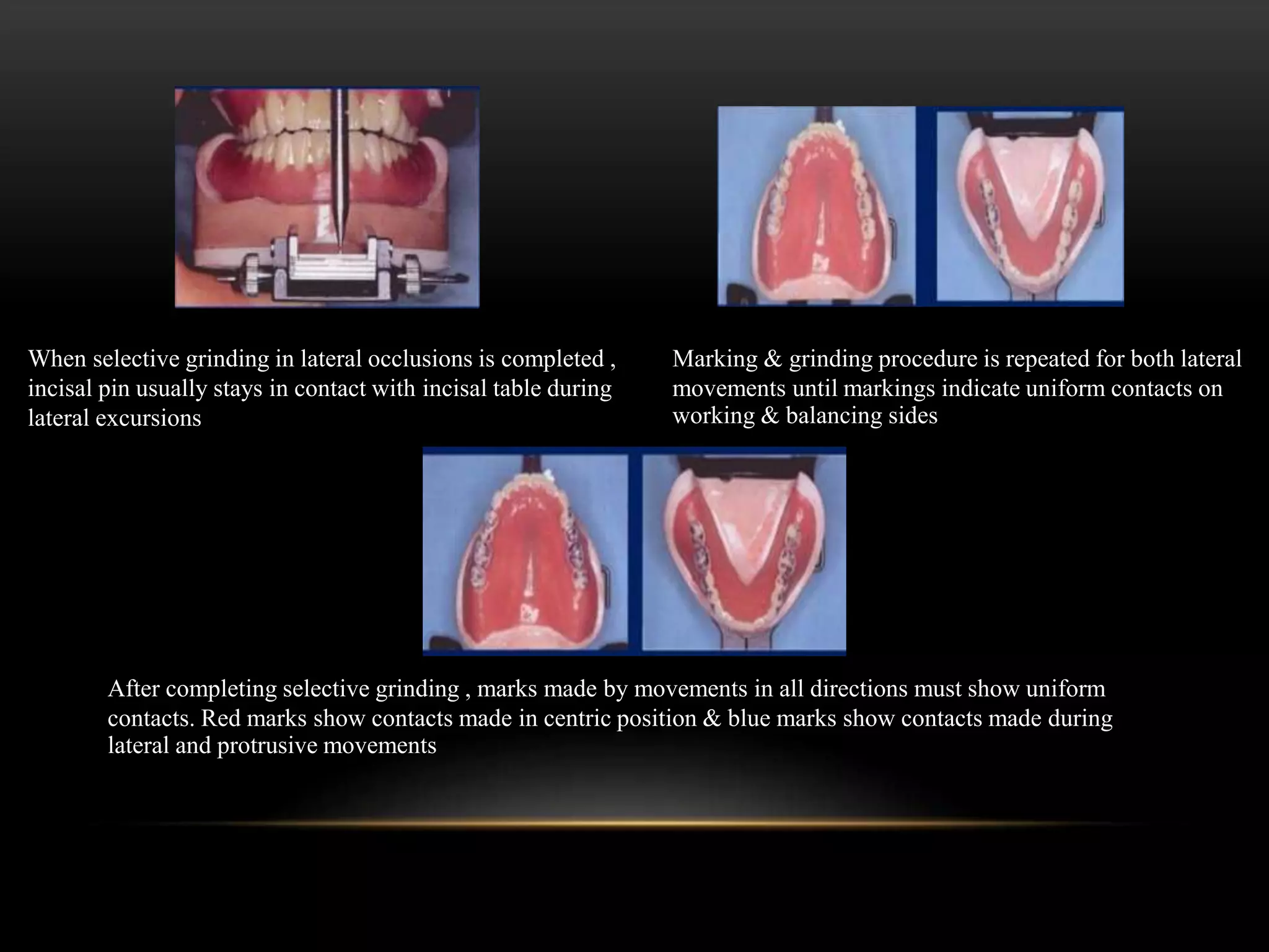 Occlusal adjustments in cd | PPTX