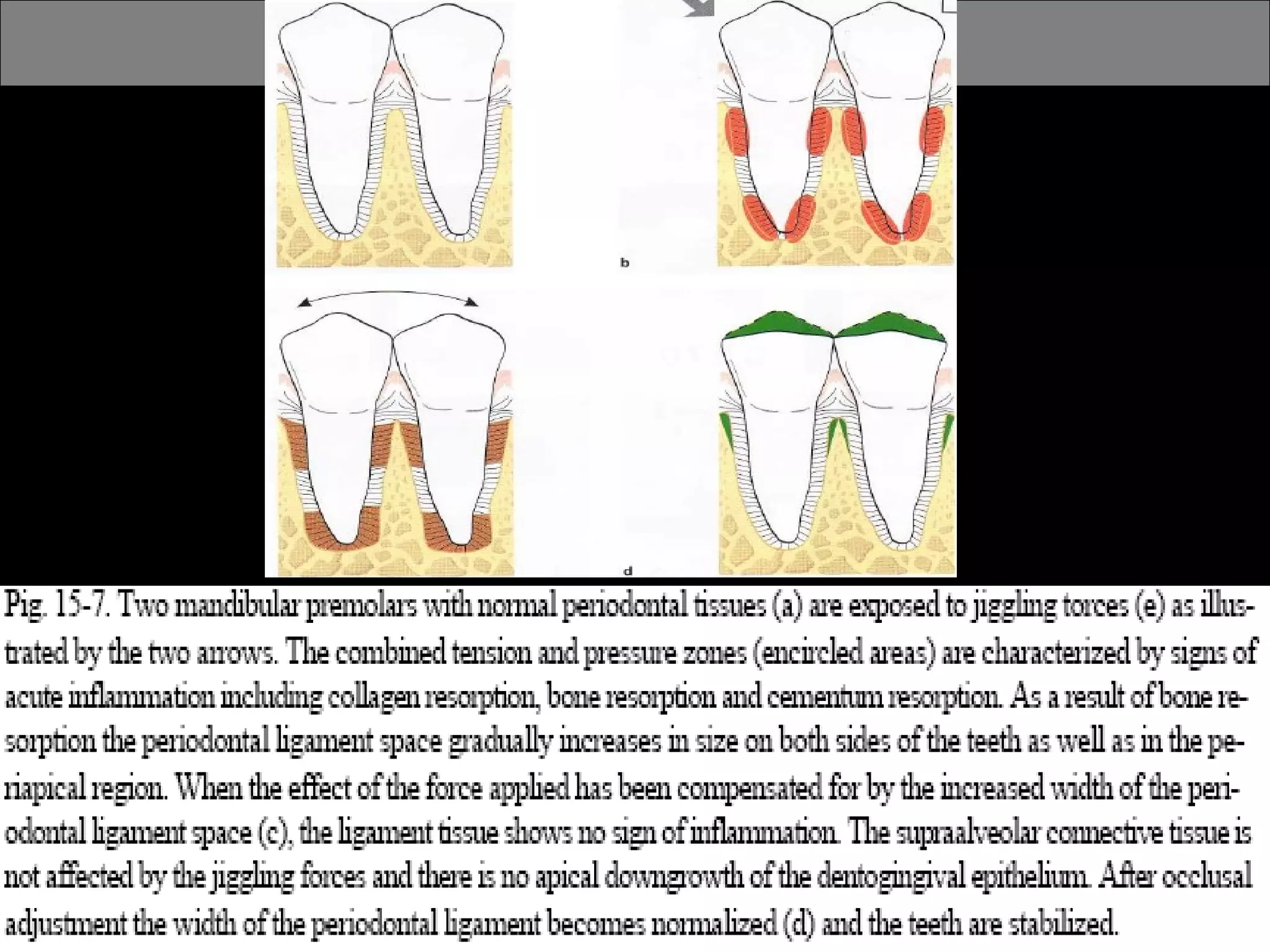 Occlusal Considerations For Implant Supported Prostheses Implant ...