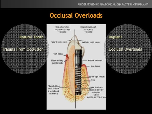 Occlusal Considerations For Implant Supported Prostheses Implant ...