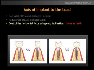 Occlusal Considerations For Implant Supported Prostheses Implant ...
