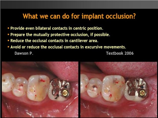 Occlusal Considerations For Implant Supported Prostheses Implant ...