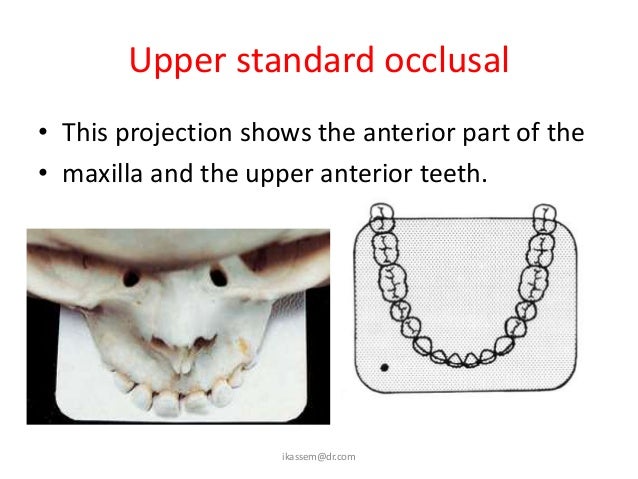 Occlusal max