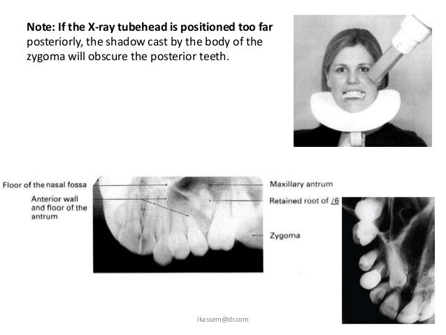 Occlusal max
