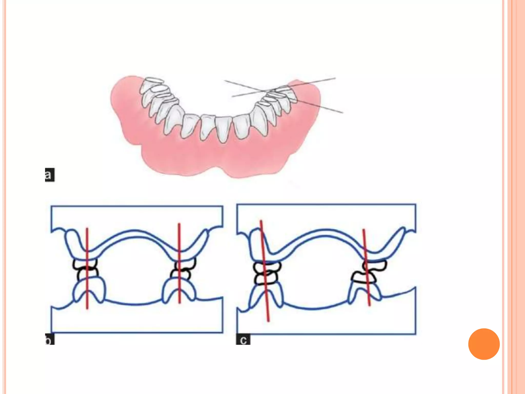 Occlusal planes and compensating curves | PPTX
